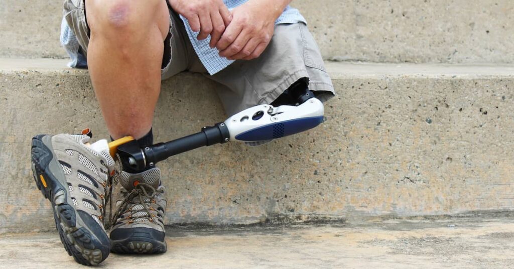 Wisconsin Amputation Injuries Attorney | Lein Law Offices